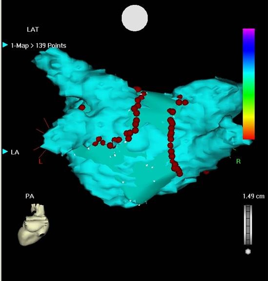 Carto及CartoMerge技术在导管消融手术中的应用,学术动态,医心网